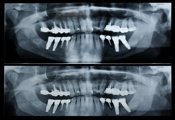 Digital Panorex - Apple A Day Dental